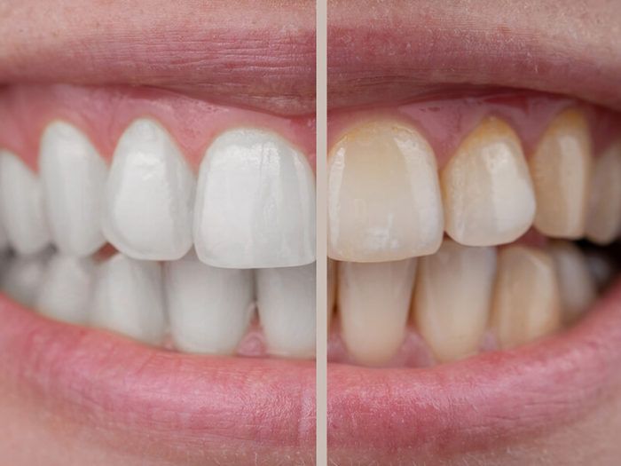 Facetas Dentárias - Conheça o segredo para ter o sorriso perfeito