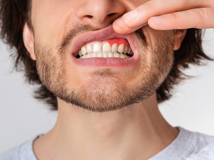 Halitose: o que é, causas e tratamento - Seletto em Taubaté