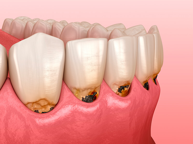 Periodontite: o que é, causas e sintomas - Seletto em Taubaté
